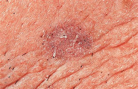 Premalignant And Malignant Nonmelanoma Skin Tumors Clinical Tree