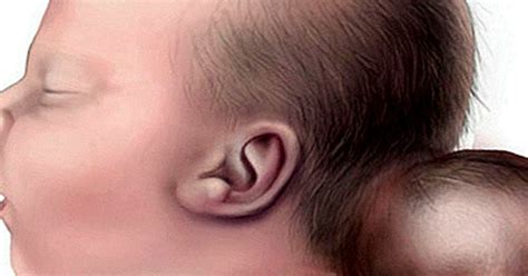 Encephalocele Types Causes Symptoms And Treatment Yes Therapy Helps