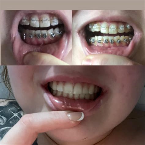 3 Years Of Treatment Later Fixed Crossbite Overbite Crowding Second