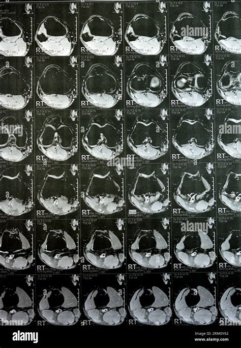 Mri Of The Right Knee Showing Mild Joint Effusion With Normal Other Findings Of Phmm Acl Mcl