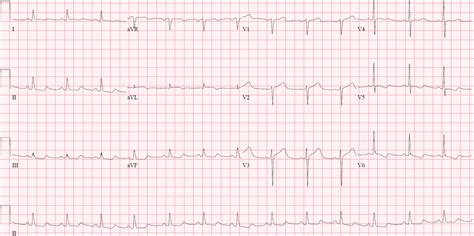 Aortic Dissection Archives Dr Smiths Ecg Blog