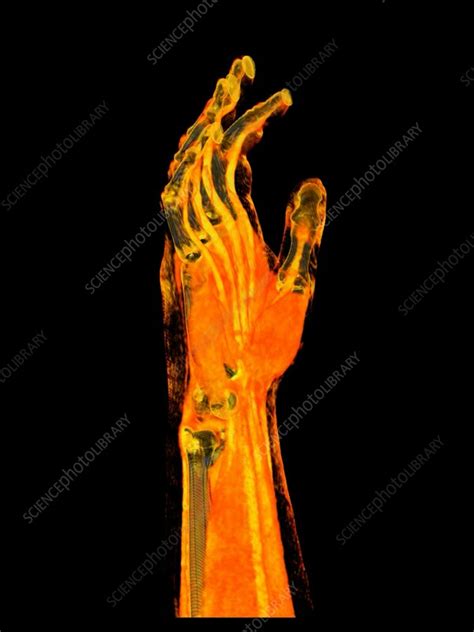 Hand And Wrist Ct Scan Stock Video Clip K0145275 Science Photo