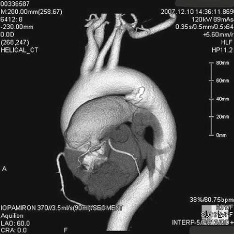 Preoperative Computed Tomography Ct Scan Showing A Large Patent Download Scientific Diagram