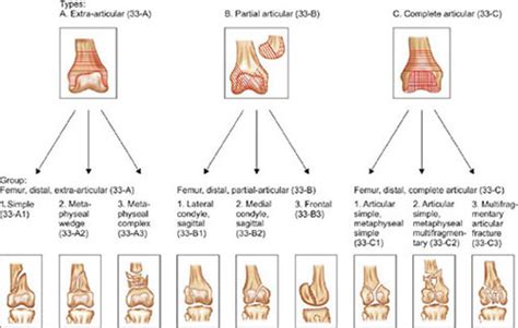 Classification Of Distal Femur Fractures And Their