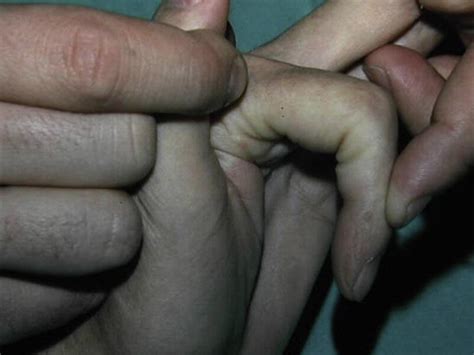 Intrinsic Contractures Of The Hand Hand Clinics
