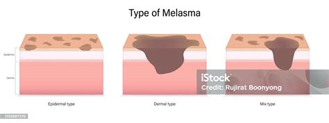 Type Of Melasma Vector Epidermal Dermal And Mix Type Facial Skin