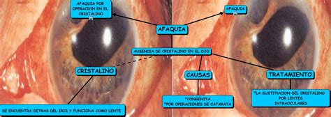 Afaquia ¿que Es Afaquia