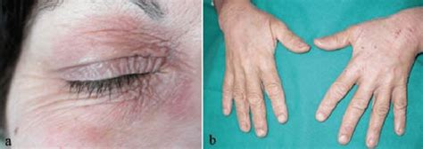 A Blepharitis And Eczema On Eyelids Before Treatment B