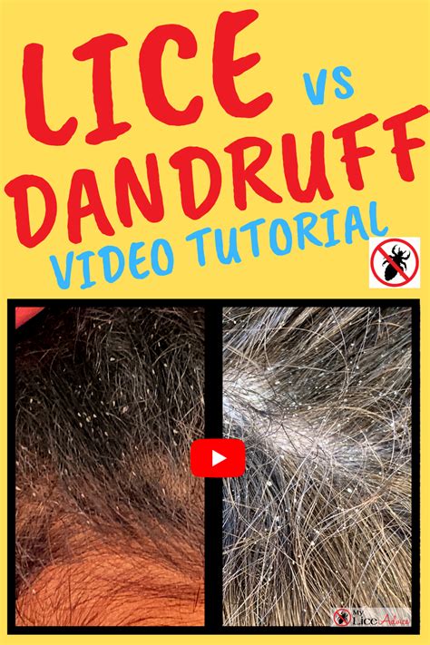 Dry Scalp Vs Lice