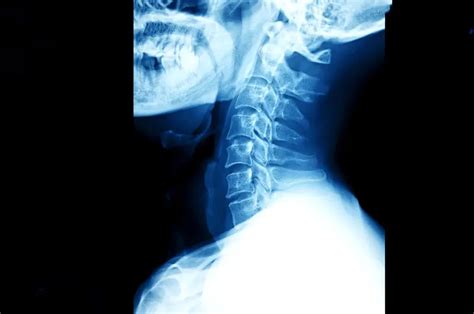 Cervical Disc Disorders And Displacements Icd 10 Coding