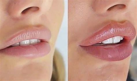 Russian Lip Filler Technique Types Cost Duration Beautygol