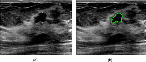 Diffuse Optical Tomography Using Semiautomated Coregistered Ultrasound Measurements