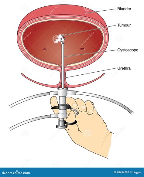 Cystoscopy Clipart And Illustrations