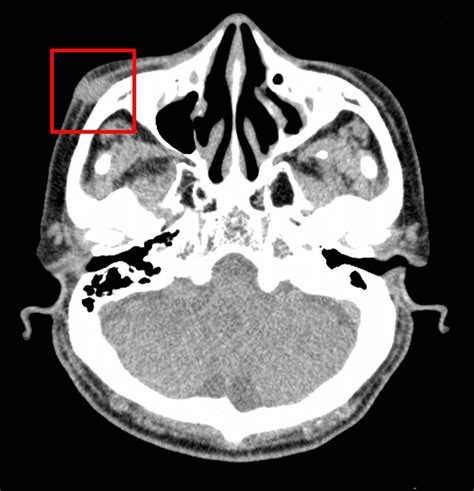 Plain Ct Image Of The Cheek A Mass In Contact With The Zygomatic Bone