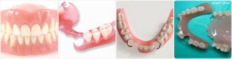 Съемные зубные протезы: виды и материалы | Стоимость съемного ...