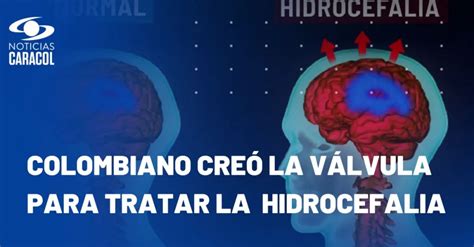 ¿qué Es La Hidrocefalia Y Cómo Se Puede Tratar Noticiascaracol