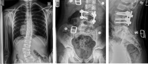 Surgical Resection Of The Lumbar Hemivertebra Ekcref Foundation