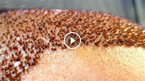 When Can I Remove Scabs After A Hair Transplant
