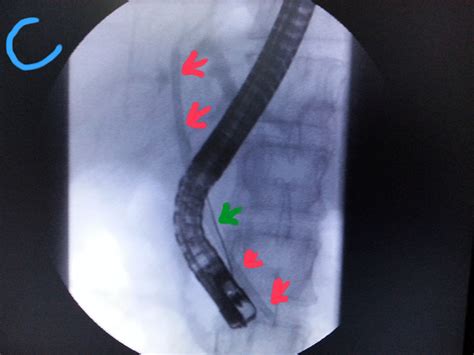 Ercp And Egd Post Cholecystectomy Cbd Stricture