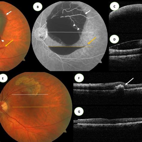 A Fundus Photography Of A Patient With A Subretinal Hemorrhage Due To Download Scientific