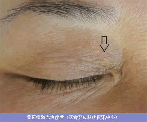 黄斑瘤 医专荟皮肤疣资讯中心