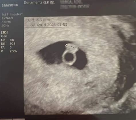 عجیب اما واقعی؛ زایمان معجزه‌آسای زنی که با دو رحم و دو واژن به دنیا