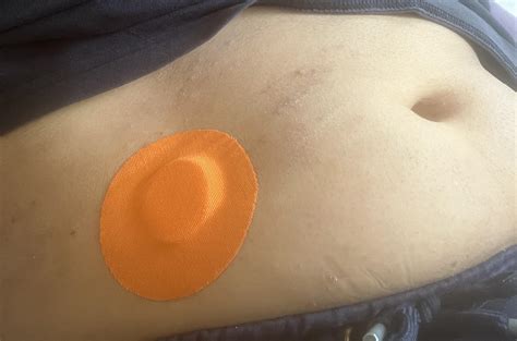 Advice On Sensor Positioning Rfreestylelibre