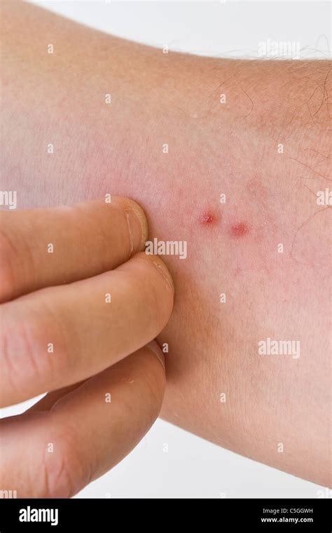 Punture Di Insetti Immagini E Fotografie Stock Ad Alta Risoluzione Alamy