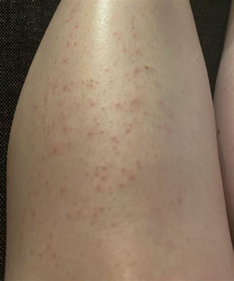 Shaving Rash Help Mumsnet
