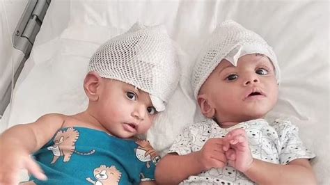 ‘머리 붙은 채 태어난 가장 드문 샴쌍둥이 분리 성공해 화제… 모습 봤더니