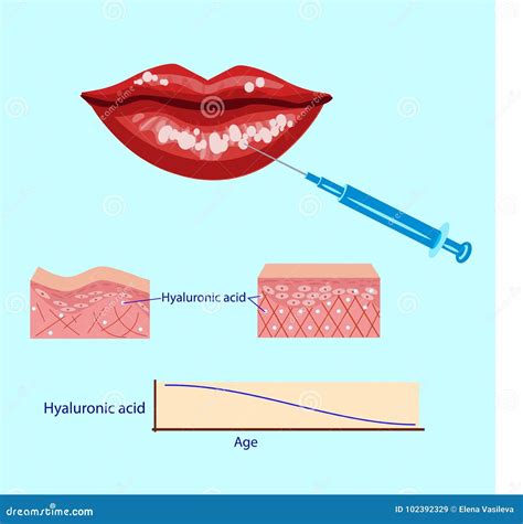 Hyaluronic Acid Injectionlips Procedure Vector Illustration Diagram