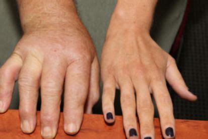 Scleroderma Symptoms And Treatment Lupton Dermatology