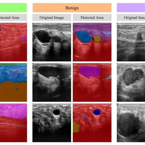Results Of Segmentation Using Sam Method With Ultrasound Images