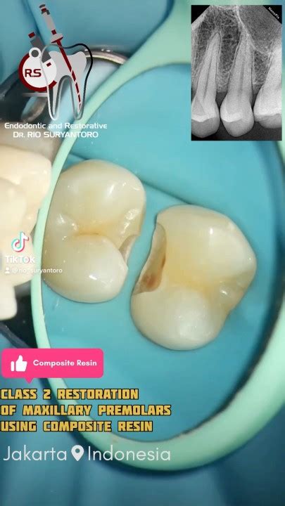 Rio Suryantoro Drg Sp En Linkedin Class 2 Restoration On Maxillary