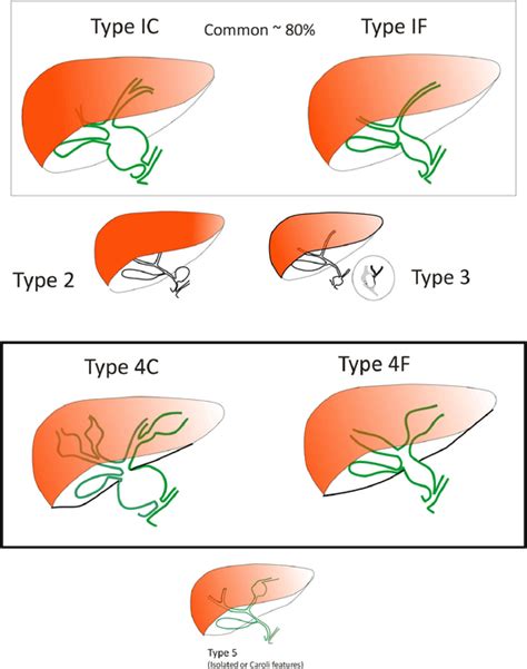 Kings College Hospital Classification Of Choledochal Malformation Download Scientific Diagram