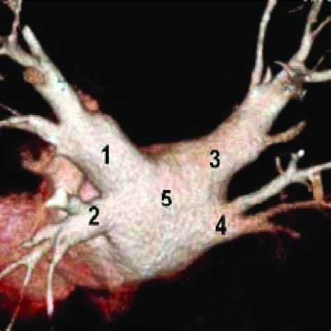 Flow Chart Of Repeat Ablation Procedures Pvi Pulmonary Vein Isolation