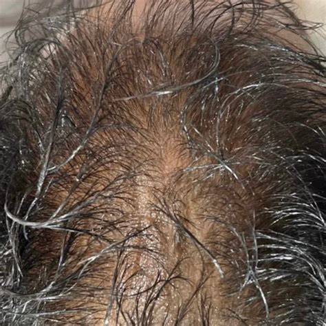 Exosomes Treatment Skin Rejuvenation And Hair Restoration Signature