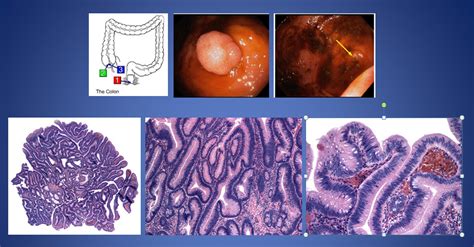 Exported Post Polypectomy Cecal Bleed