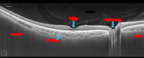 OCT Angiography Flashcards Quizlet