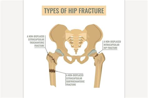 Types Of Hip Fracture Hip Fracture Fracture Hips