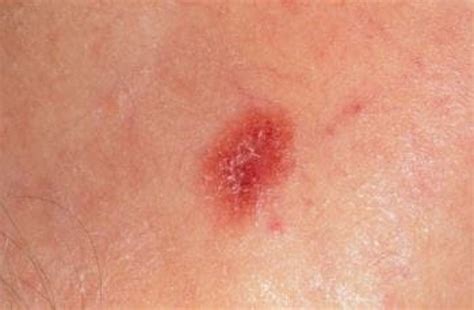 Amelanotic Melanoma The Chelsea Clinic Chiropodists Podiatrists