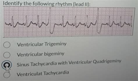 Solved Identify The Following Rhythm Lead Ii Ventricular Trigeminy Ventricular Bigeminy