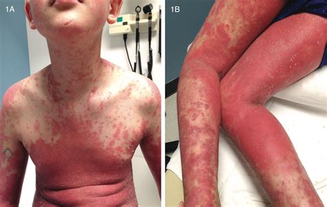 Pediatric Psoriasis Comorbidities