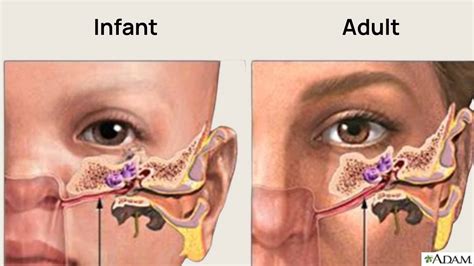 Ear Infection Bubbling At Keith Maxey Blog