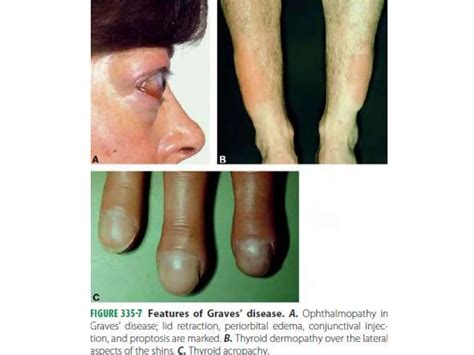 Hyperthyroidism About Goiter Medical Ppt Pptx