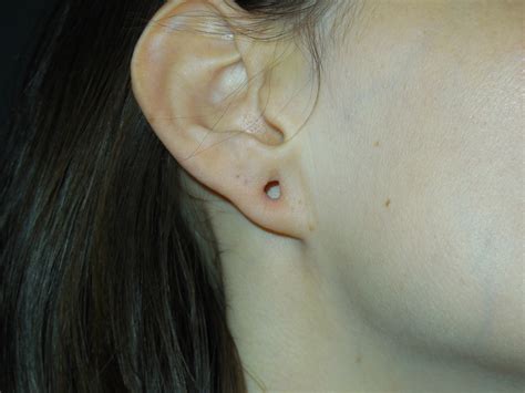 Ear Lobe Repair Dr Cynthia Goodman