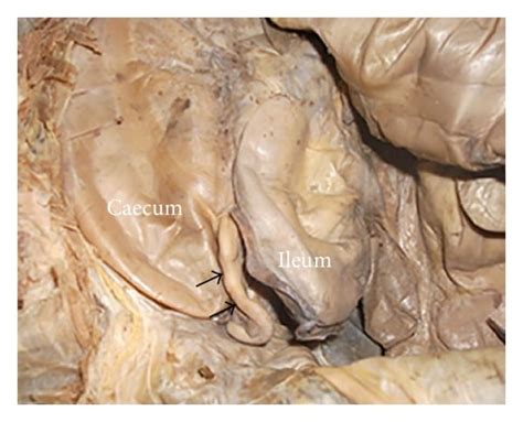 Position Of The Appendix Arrow A Retrocecal Appendix Note The Download Scientific Diagram