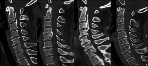 The Four Types Of Cervical Opll Continuous Local Mixed And