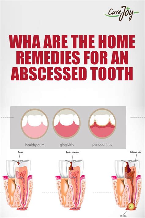 How To Reduce A Tooth Abscess Swelling At Linda Redmon Blog