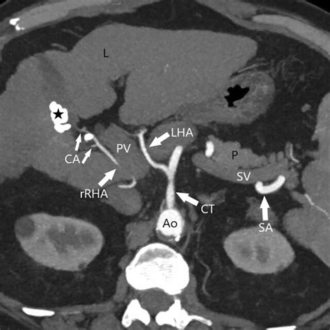 Contrast Enhanced Computed Tomography Angiography Axial Image At The Download Scientific
